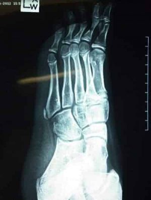 Pediatric Lateral Foot Pain: Causes and Expert Care