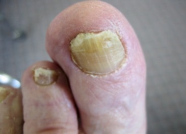 Toenail Problem Guide | My Foot Dr Singapore
