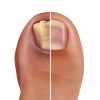 Curing Foot Rot: A Comprehensive Guide | My Foot Dr