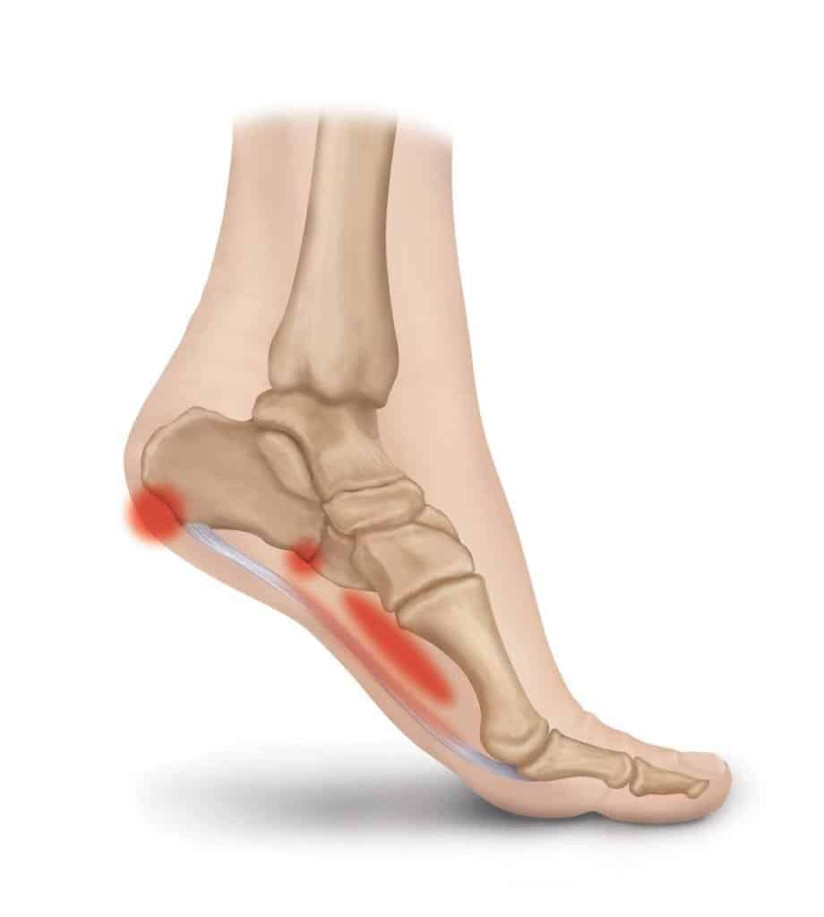 Heel Pain Explained: What You Need to Know | My Foot Dr
