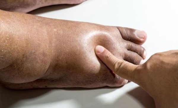 Lower Limb Swelling: Causes and Solutions | My FootDr