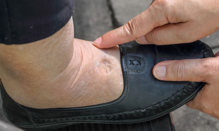 Lower Limb Swelling: Causes and Solutions | My FootDr