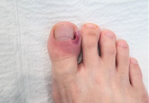 Paronychia Symptoms: What to Look for in Infected Fingers and Toes
